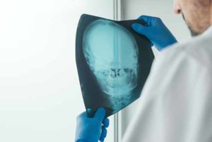Facial Fracture Series, Part 3: Diagnosis and Treatment of Facial ...