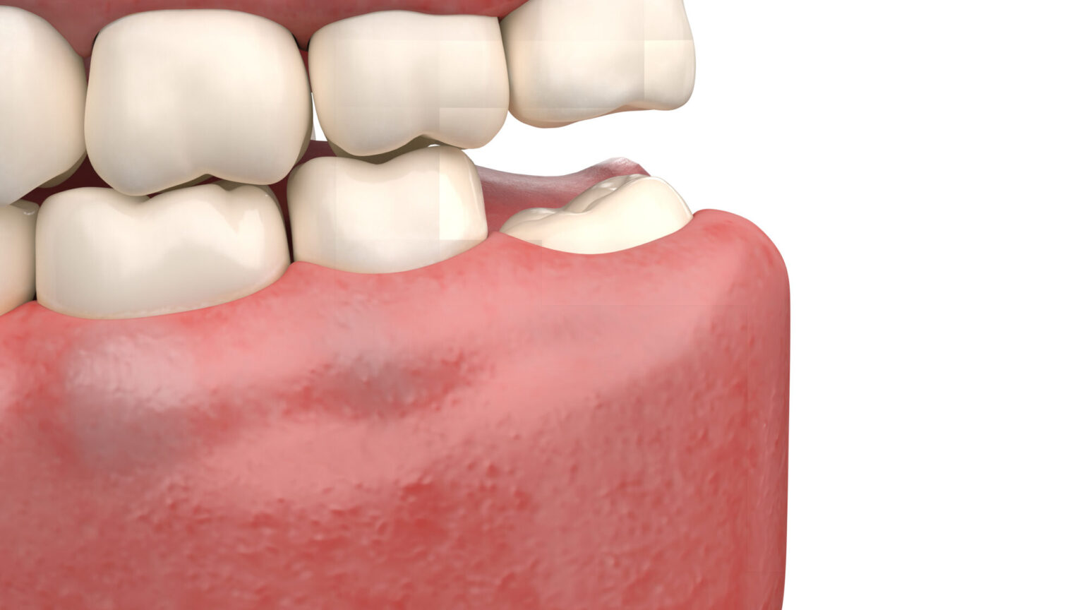 What Are Impacted Teeth?