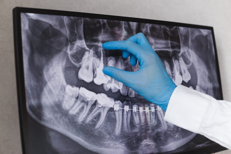 What Is MRONJ? (And Other FAQs) - Athens Oral Surgery Center