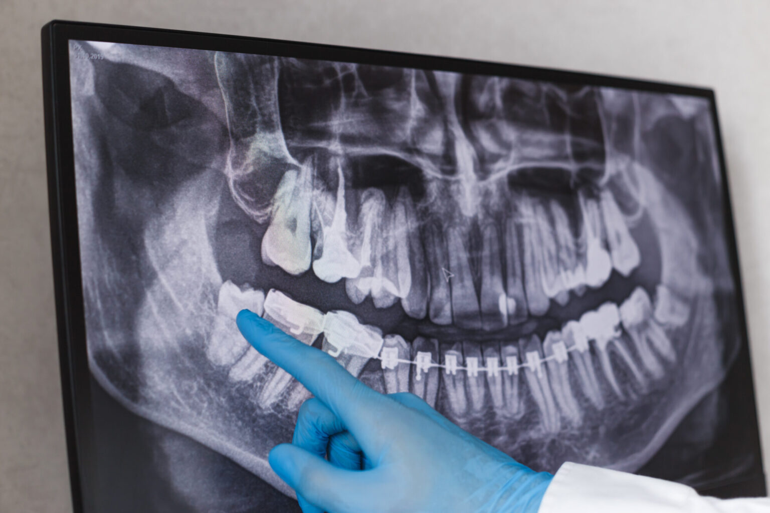 Why Choose an Athens, Ga Oral Surgeon for Wisdom Tooth Extraction ...